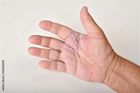 A New Chapter Begins Trigger Finger Surgery Unveiled Institute Of