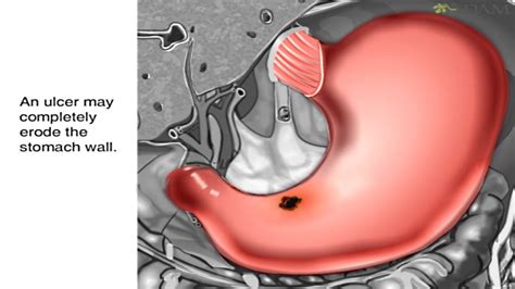 How Stomach Ulcers Form Animation Peptic Ulcer Disease Causes