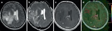 成人型和儿童型弥漫性胶质瘤clinical Neuroradiology X Mol