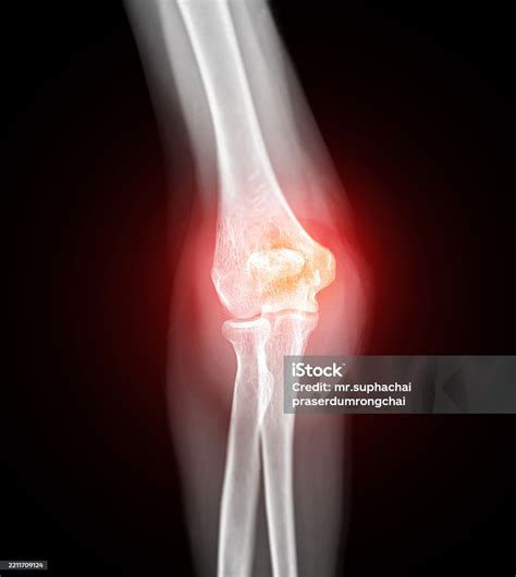 An Xray Image Showing A Fracture Of The Olecranon Process Of The Ulna