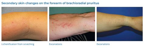 ‘golfers Vasculitis Summer Leg Rash My Notes