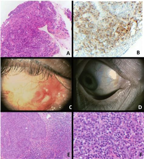 Conjunctival Biopsy Of Case 2 Panel A Haematoxylin Eosin Staining