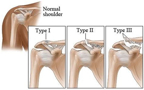 Acromioclavicular Joint Dislocation Treatment