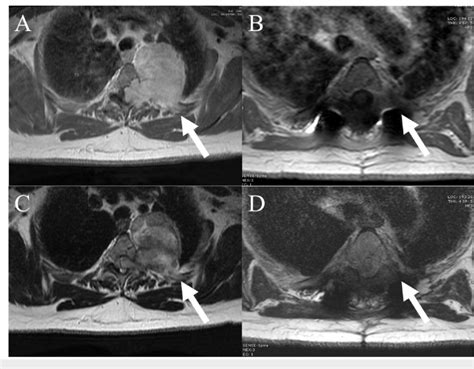 Comparison Of Preoperative And Postoperative Mri Thoracic Spine With