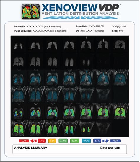 Kitware Supports Development And Launch Of Fda Cleared Mr Image Processing Software For Lung