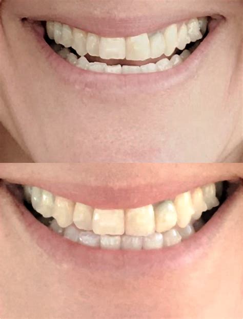 Mewing Before After Results 70 Crazy Transformations