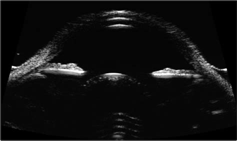 Ultrasound Biomicroscopy Ubm Image Of The Left Eye Prior To The