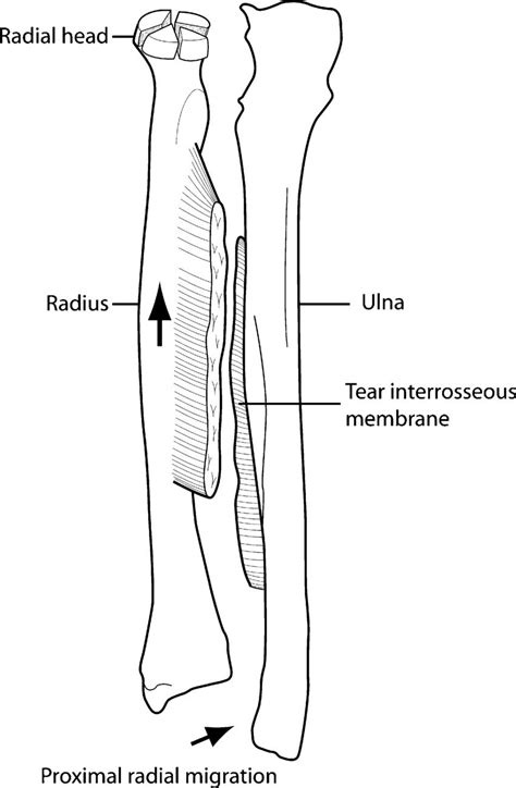 Head Of Radius