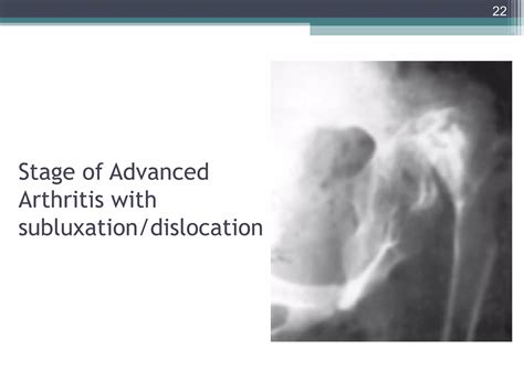 Tuberculosis Of Hip And Knee Ppt
