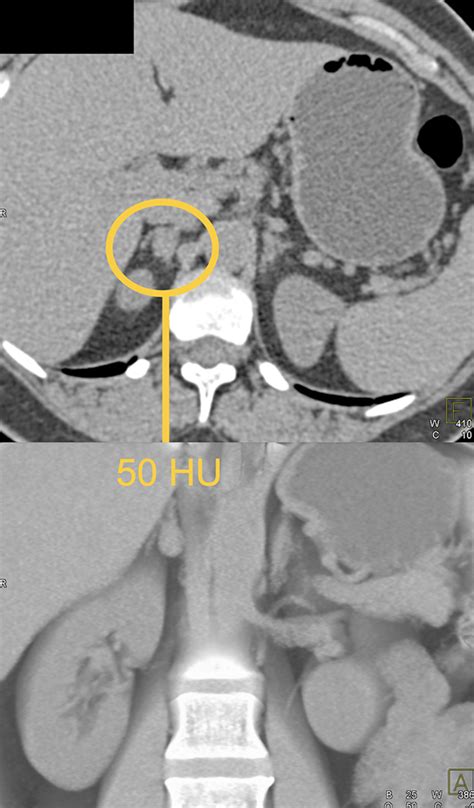 Gastrointestinal Learning Modules Ct Scanning