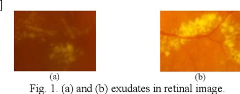 Figure 1 From Automatic Exudates Detection In Retinal Images Using