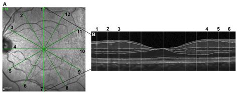 Oct Segmentation Pattern A Fundus View Oct Segmentation Along 12
