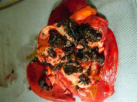 Liver Surgery Photos