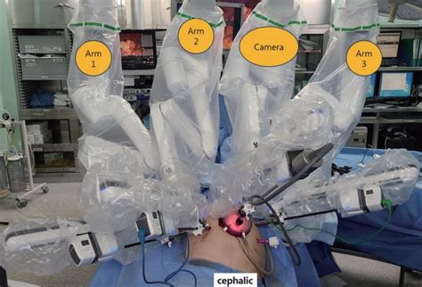 Standardized Step By Step Technique Using Surgical Landmarks In Robotic Lateral Pelvic Lymph