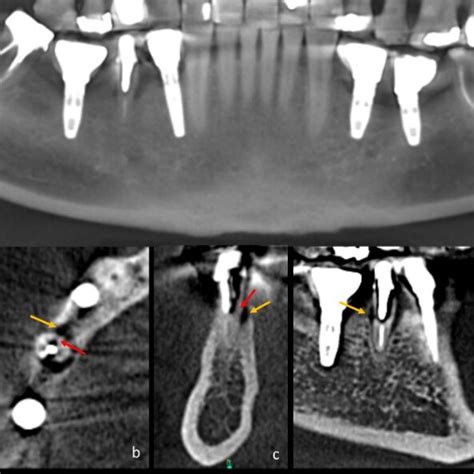 Reconstrução panorâmica a e cortes axial b sagital c e coronal