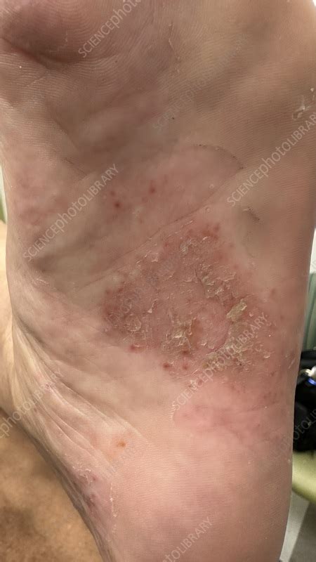 Palmoplantar Psoriasis Stock Image C0599144 Science Photo Library