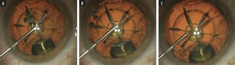 Crstoday Mitigating Challenging Surgery With Duovisc