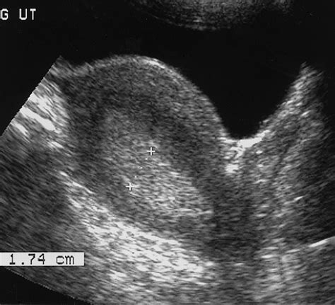 Gyn Review Proprofs Quiz