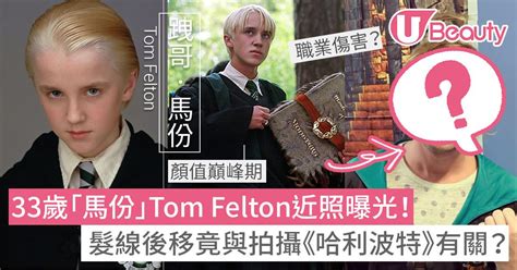 33歲「馬份」tom Felton近照曝光！頭髮稀疏髮線後移！顏值倒退竟與拍攝《哈利波特》有關？ U Beauty
