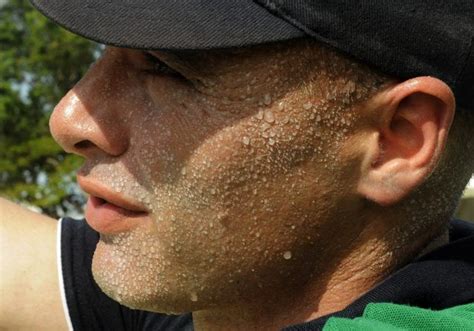 Measles Global Outbreaks Stemming From A Decline In Routine Vaccine Coverage National