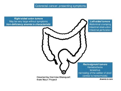 Ces 2016 02 Colorectal Cancer