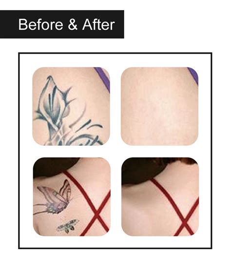Picocare Q Switched Nd Yag Laser Picosecond Laser Tattoo Removal Lutron
