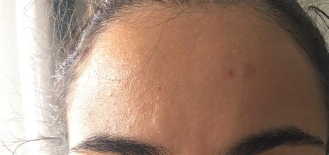 Finally Figured Out I Have Fungal Acne After Years Amazing 3 Day