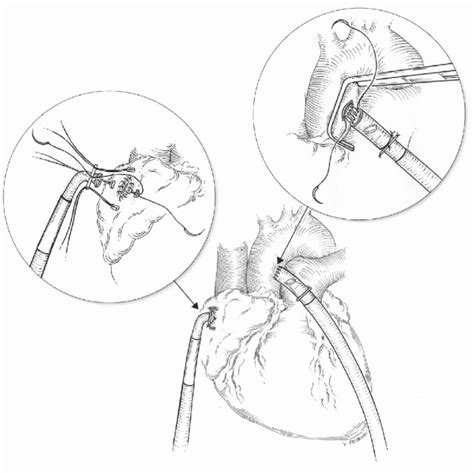 Aortic Cannulation Using Apical Berlin Heart Cannula And A 8 Mm Download Scientific Diagram