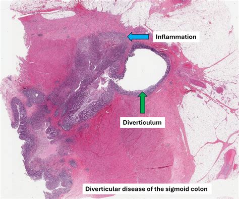 Your Pathology Report For Diverticular Disease Mypathologyreport