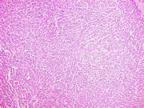 Pathology Outlines Hepatocellular Carcinoma Overview