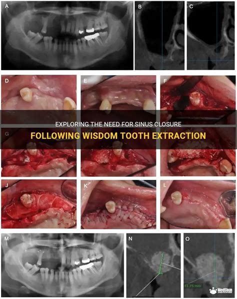 Exploring The Need For Sinus Closure Following Wisdom Tooth Extraction