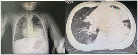 Frontiers Pediatric Necrotizing Pneumonia Case Report Clinical