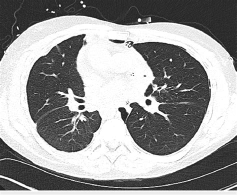 Ct Chest Prior To Hospital Discharge Download Scientific Diagram