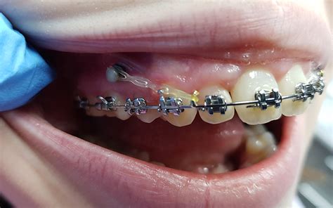 Mini Implant Ortodontic Cabinet Stomatologic Happydent Bacău