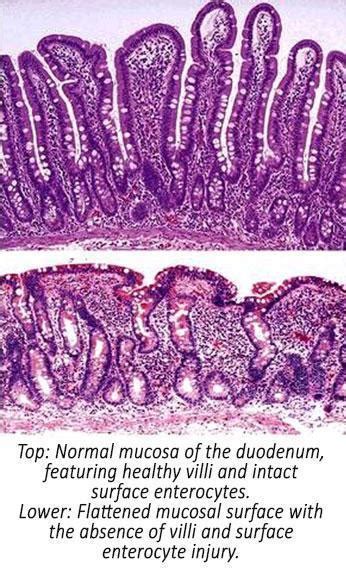 Feline Nutrition Feline Inflammatory Bowel Disease Nature And