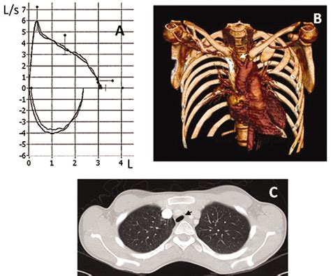 Irreversible Airway Obstruction Due To Innominate Artery Compression Of