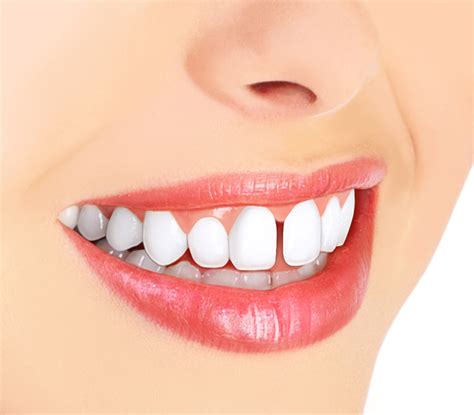 O Que É Diastema E Como Tratar Odontomania