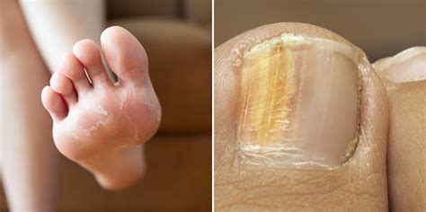 성북구 피부과 발톱무좀 증상 자세히 살펴보기 성신여대 포이즌 피부칼럼 성신여대피부과 포이즌의원