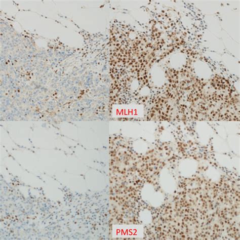 Mismatch Repair Status Evaluation Using Immunohistochemical Biomarkers Download Scientific