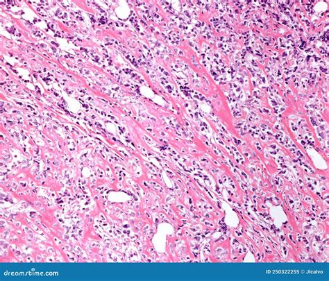 Bone Osteogenic Sarcoma Stock Image Image Of Histology 250322255