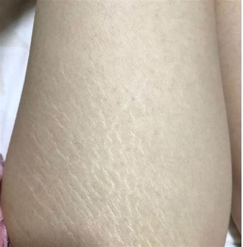 肥胖纹可以去掉吗 知乎
