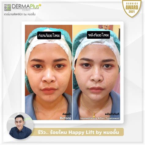 Review HappyLiftkk Dermaplus Clinic Phuket by หมออน