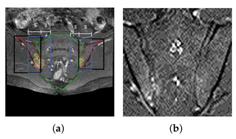 method for diagnosing the bone marrow edema of sacroiliac joint in patients with axial