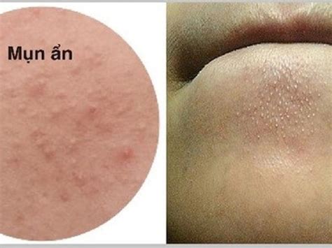 Cách Trị Mụn ẩn Dưới Cằm Triệt để Không Tái Phát