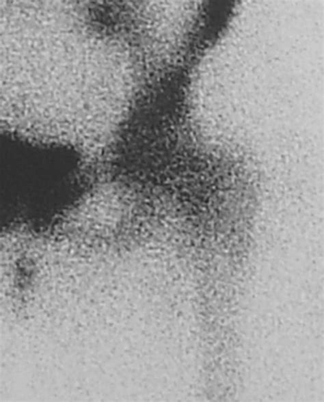 Follow Up Bone Scintigraphy 6 Months After Surgery Fracture Site And