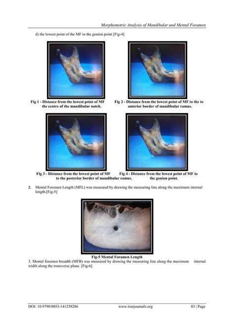 Morphometric Analysis Of Mandibular And Mental Foramen Pdf