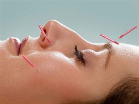 Acupuncture For Sinus Issues In Dubai Natural Relief
