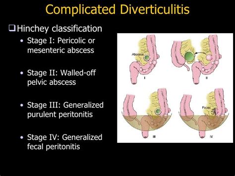 Diverticulitis