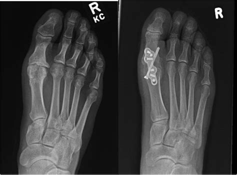 First Mtp Fusion — Dr Sagar Desai