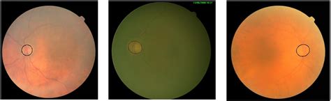 Localization And Segmentation Of Optic Disc In Retinal Images Using Circular Hough Transform And